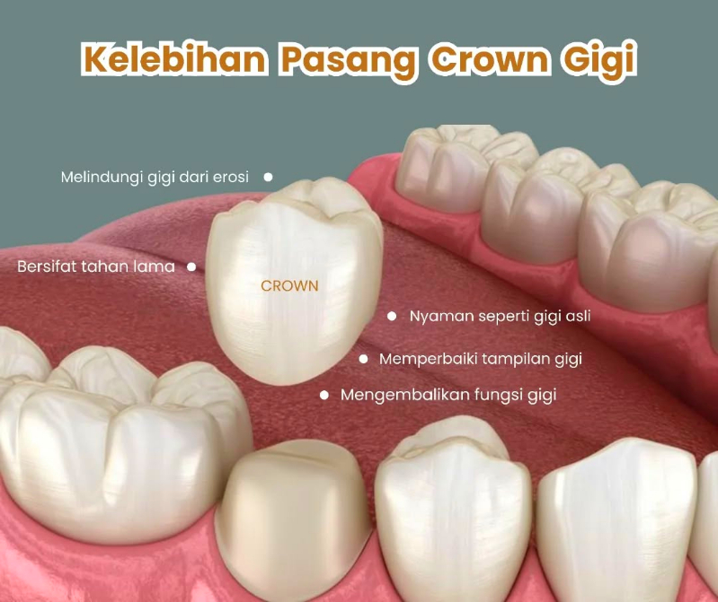 Update Biaya Pembuatan & Pemasangan Crown Gigi | Harga.web.id